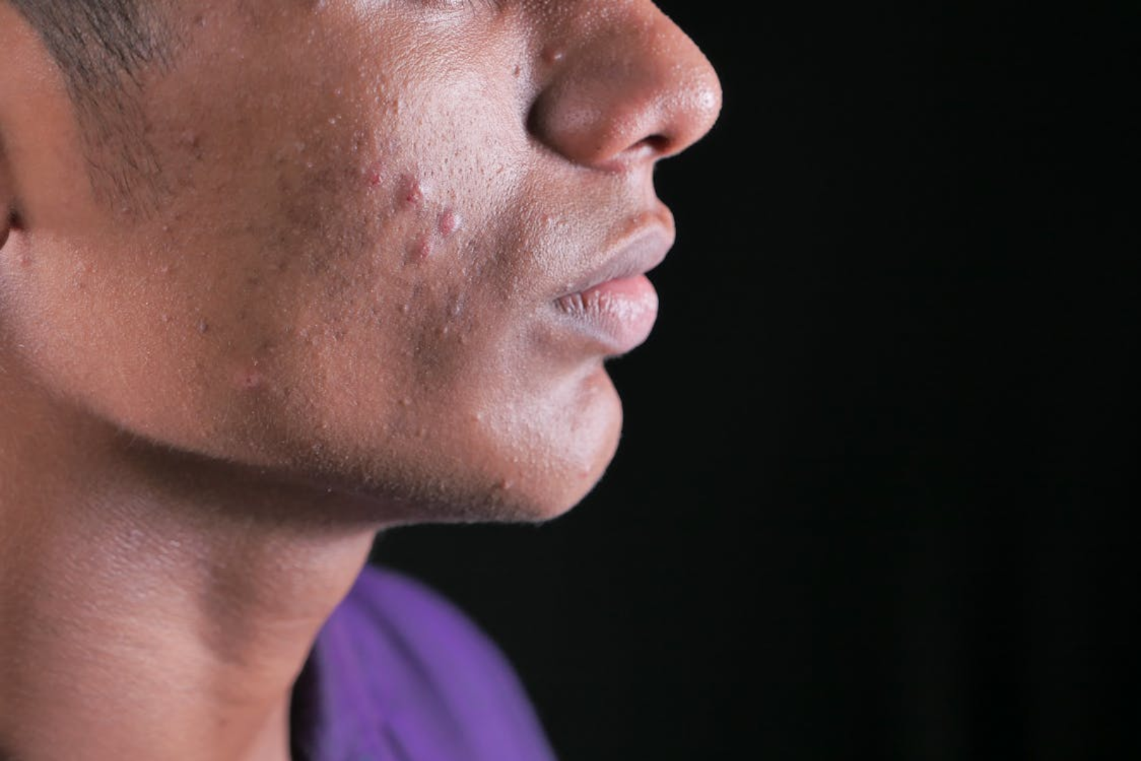 Bumps On Face Not Acne What Are They 