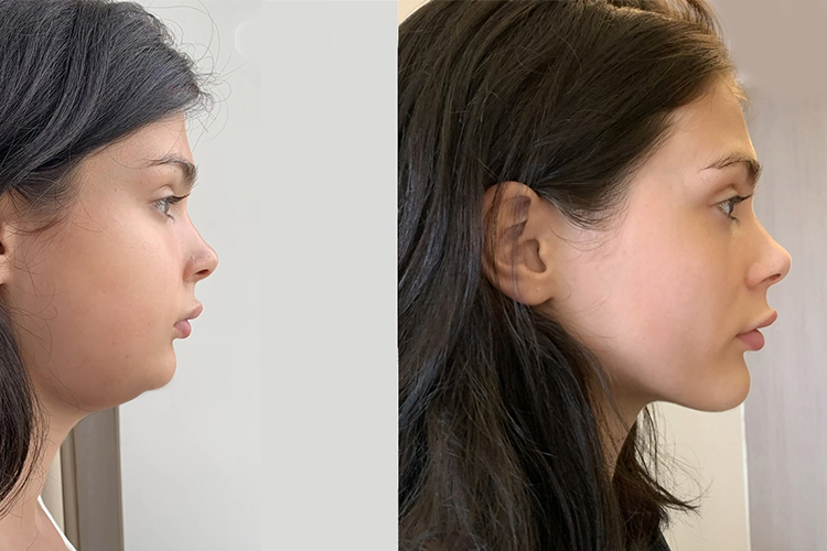 How to Slim Your Face?